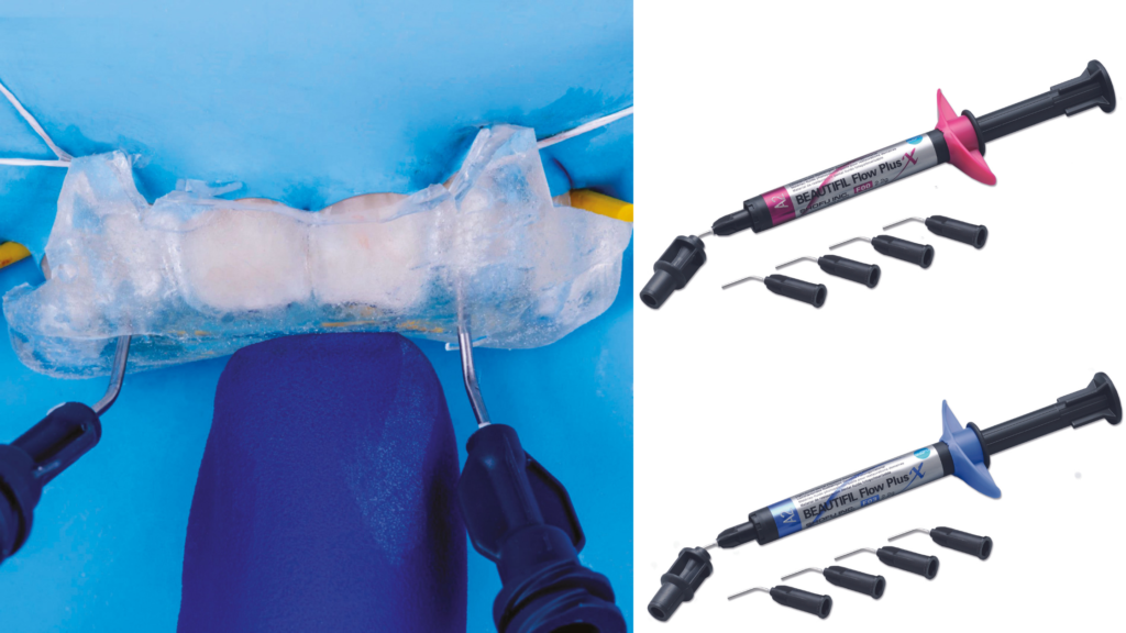 L’injection de composite | société Dexter